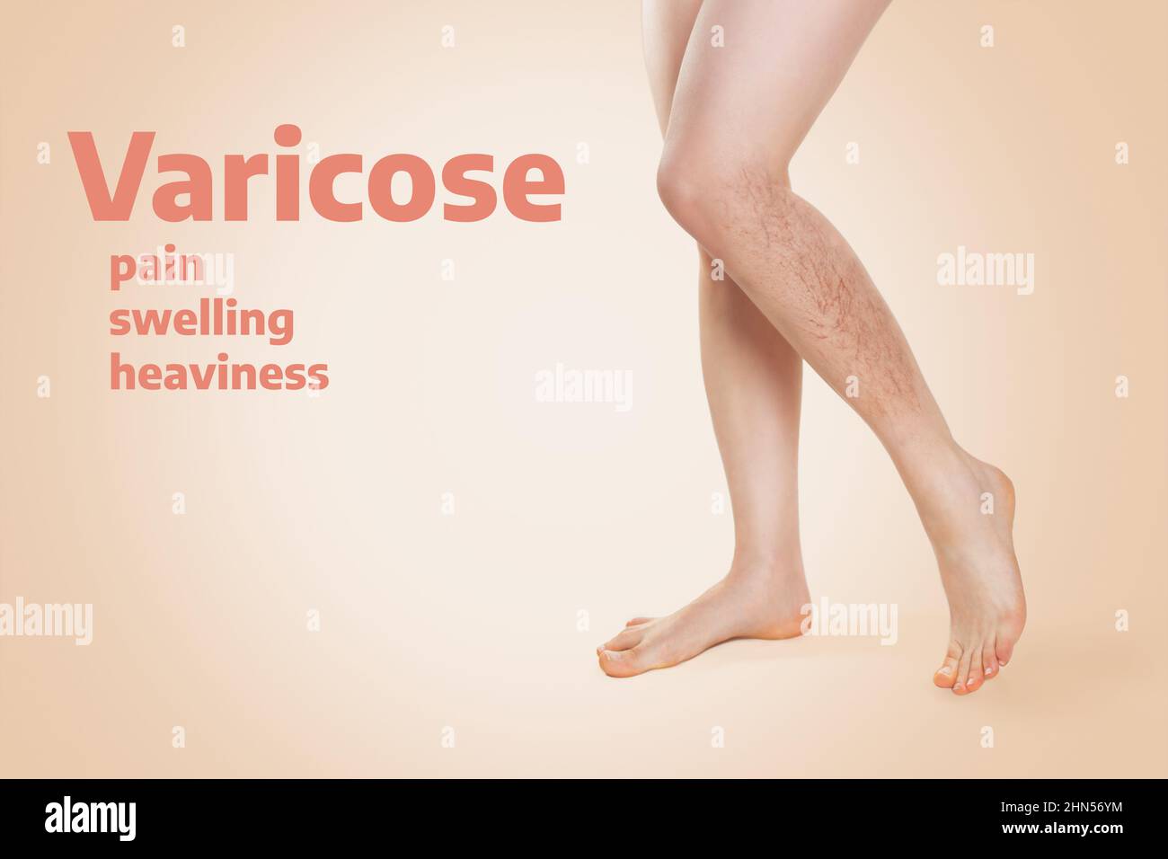 Smooth female legs, with varicose veins on the lower leg. Beige ...