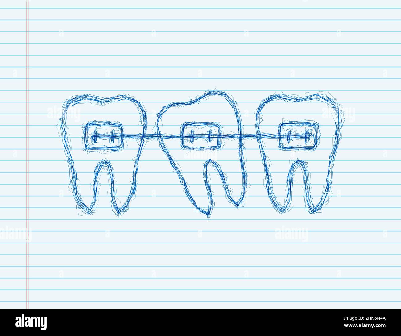 Correction of teeth with orthodontic braces. Stages of teeth alignment ...