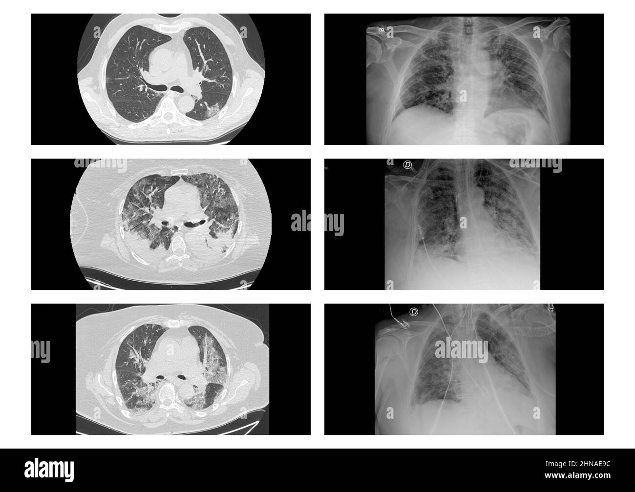 Chest x ray images hi-res stock photography and images - Alamy
