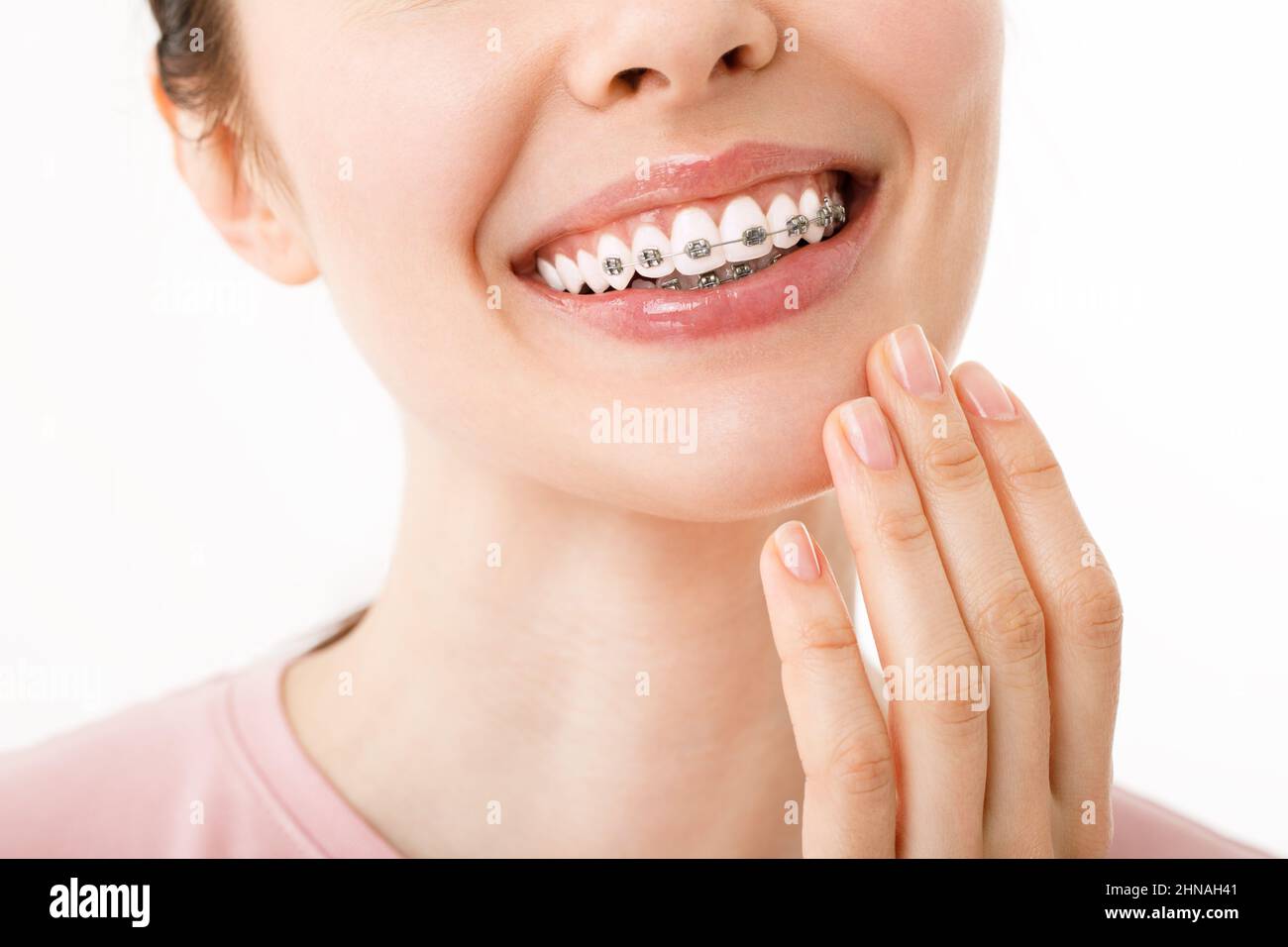 Smile with Braces Orthodontic Treatment. Dental Care Concept. Beautiful ...
