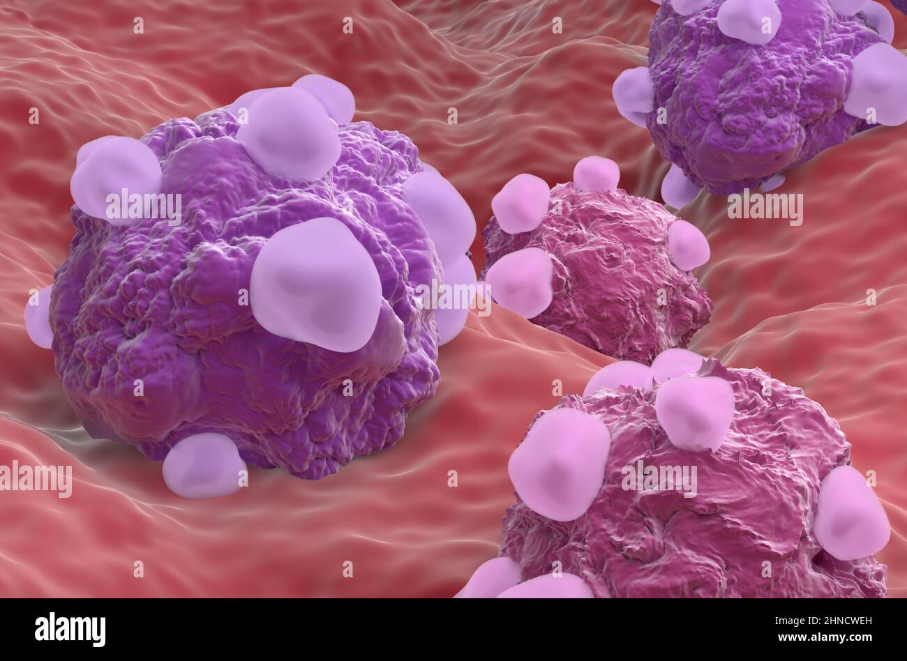 Ovarian cancer cell variations - closeup view 3d illustration Stock ...
