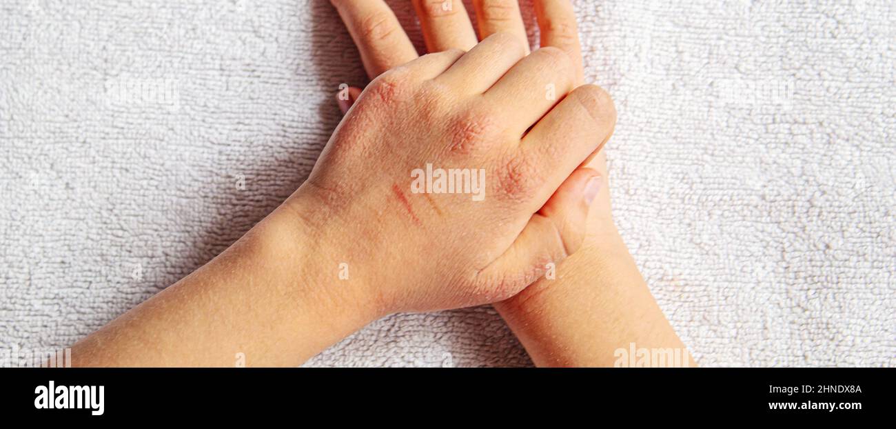 Red spots on the skin of the child's hands.children's allergy.selective ...