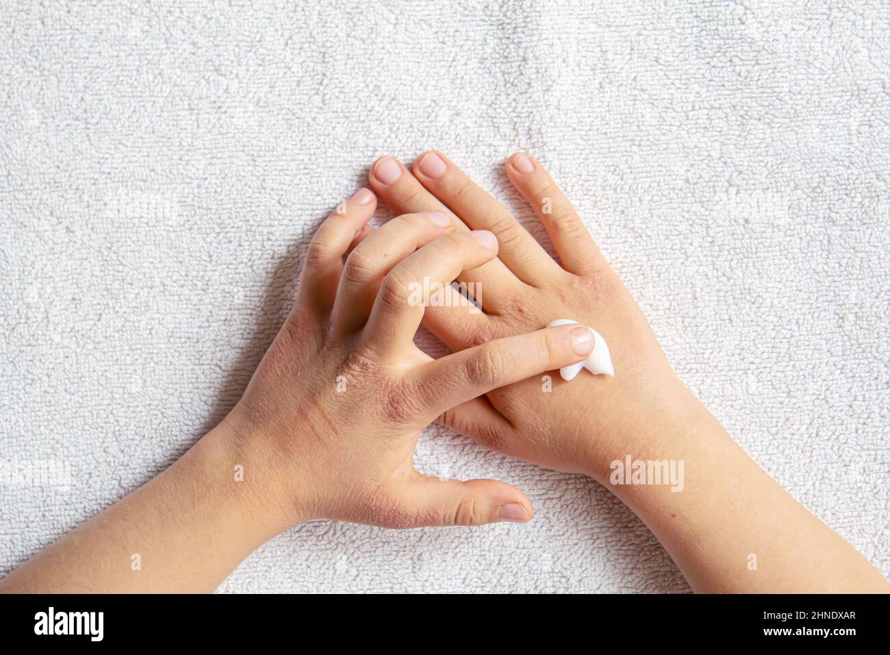 Red spots on the skin of the child's hands.children's allergy.selective ...