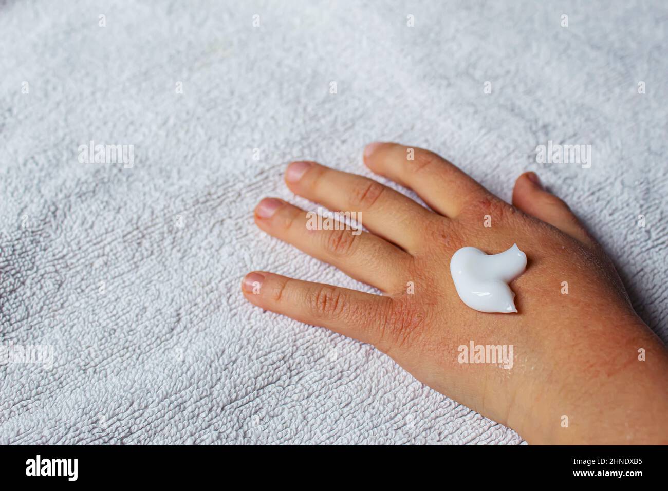 Red spots on the skin of the child's hands.children's allergy.selective ...