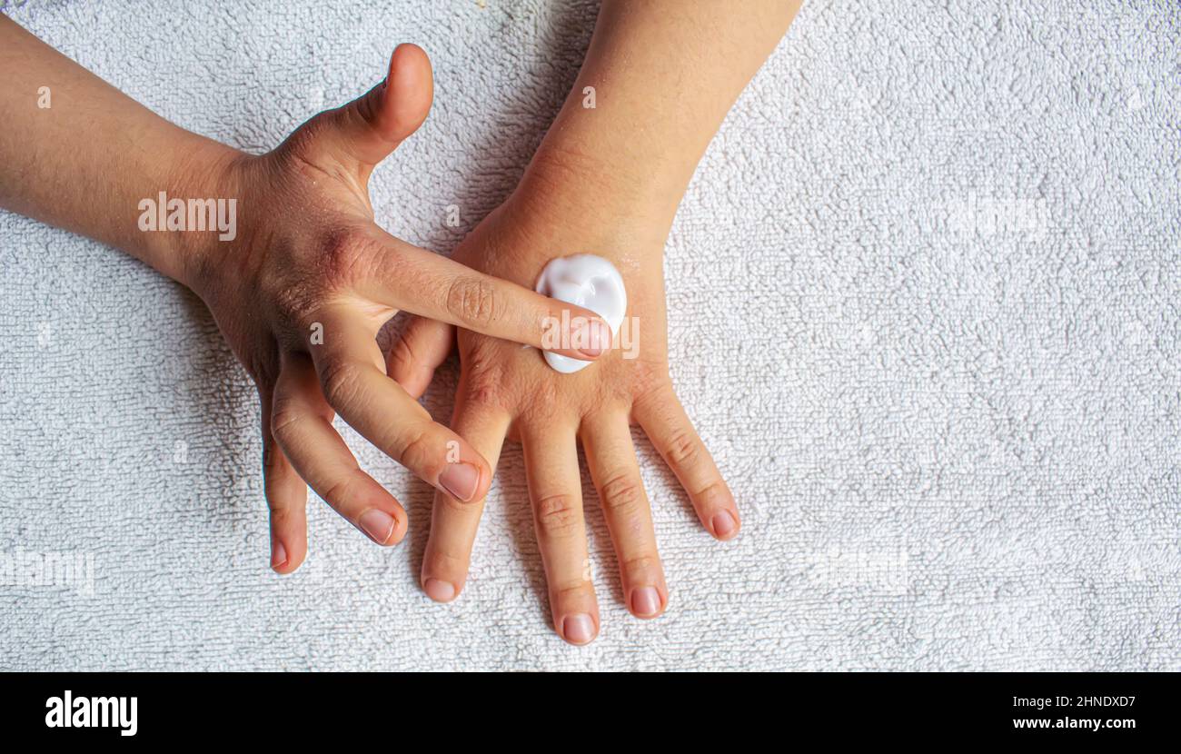 Red spots on the skin of the child's hands.children's allergy.selective ...