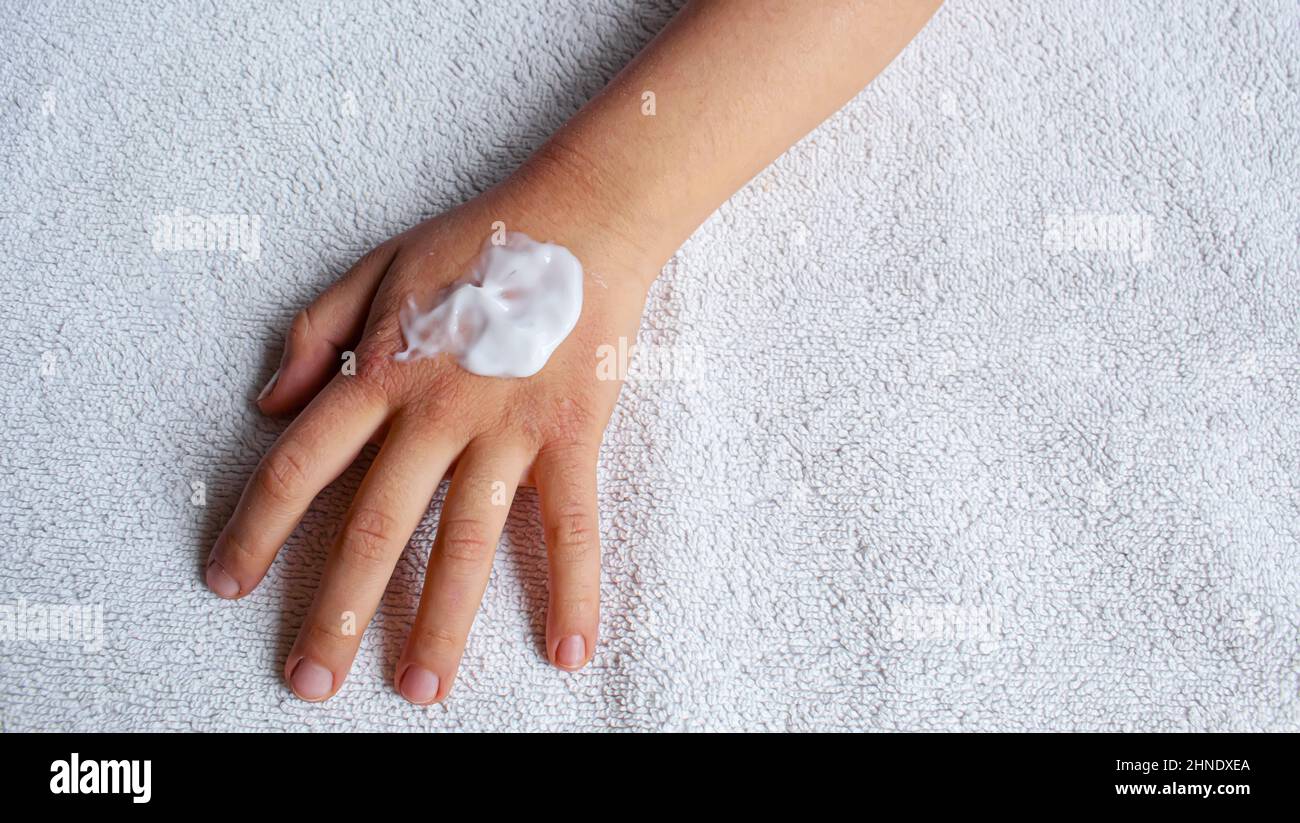 Red spots on the skin of the child's hands.children's allergy.selective ...