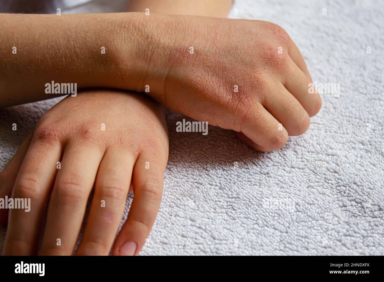 Skin rash eczema on hands hi-res stock photography and images - Alamy