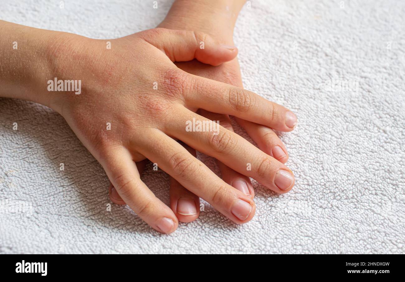 Red spots on the skin of the child's hands.children's allergy.selective ...