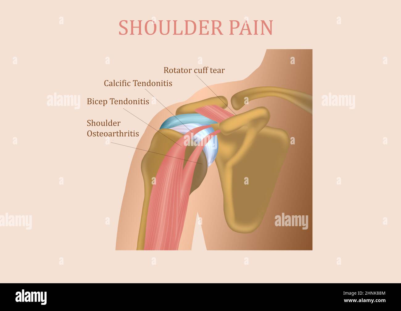 Subacromial bursitis hi-res stock photography and images - Alamy