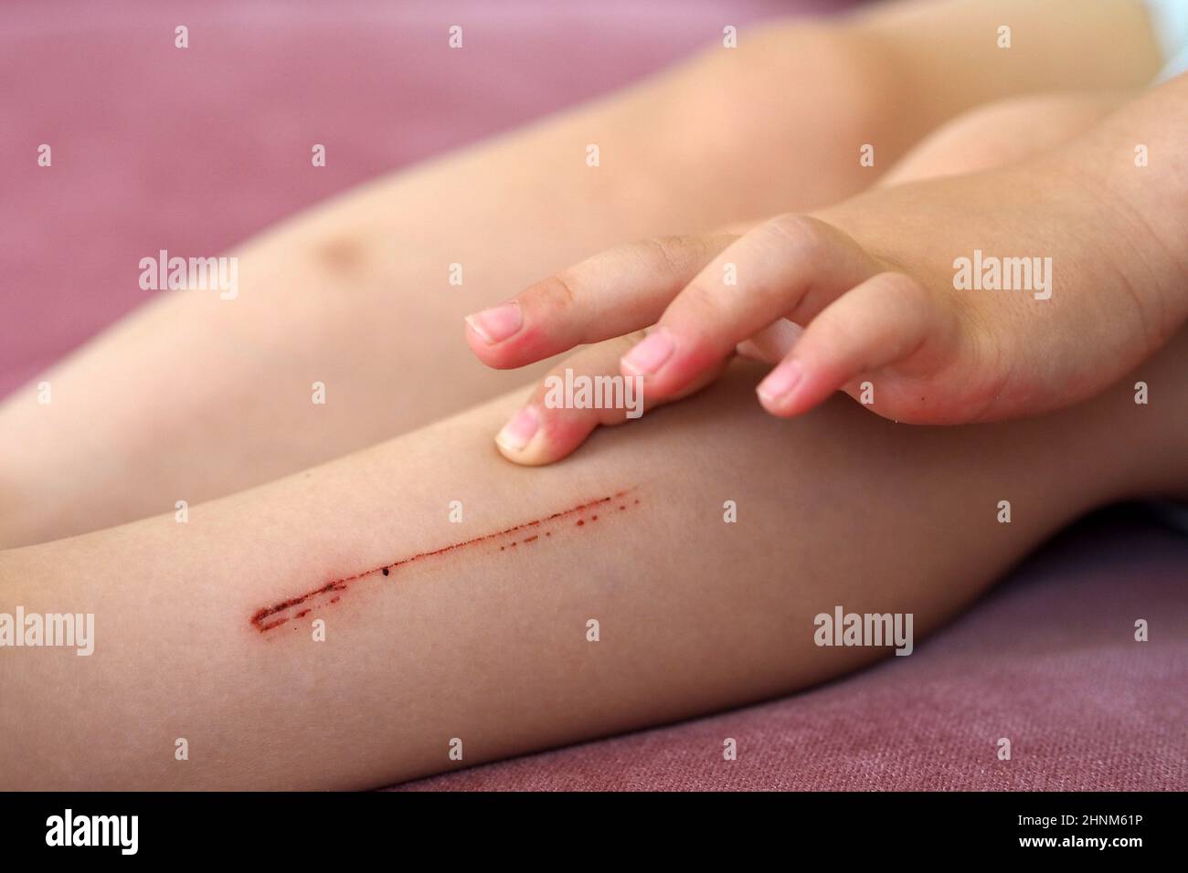 a scratch wound that forms a trace on the leg, the child's leg is ...