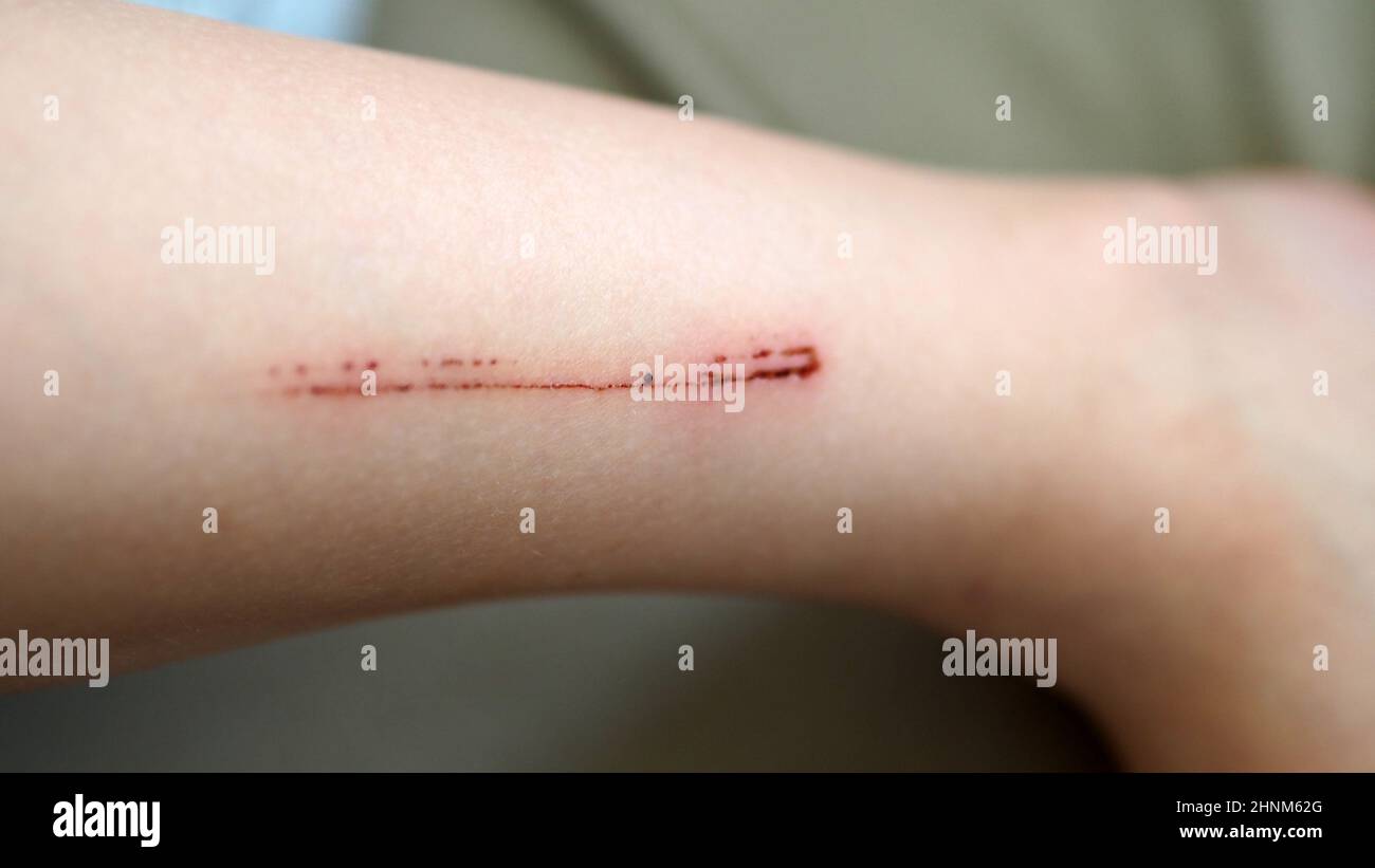 a scratch wound that forms a trace on the leg, the child's leg is ...