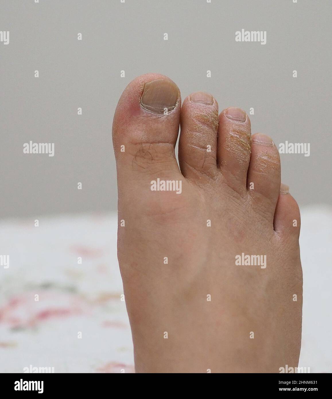 neglected male toes, fungus toes, fungal disease, calluses on toes ...