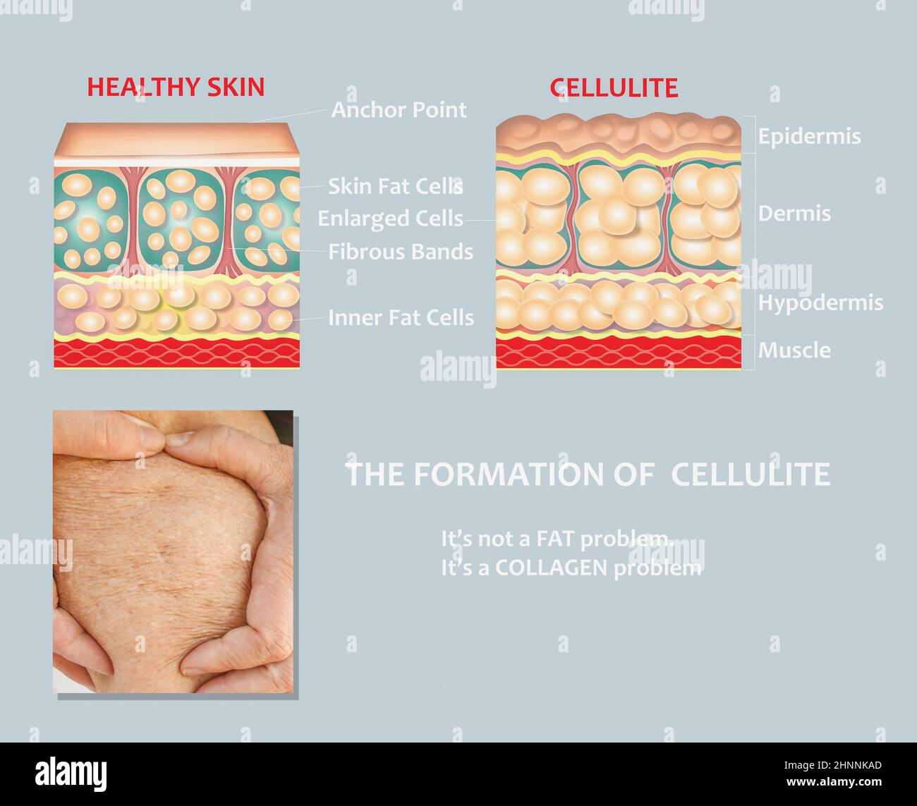 Adipose tissue illustration hi-res stock photography and images - Alamy