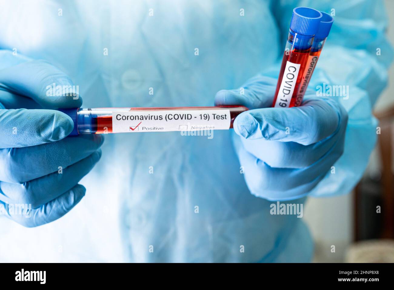 Positive blood infection sample in test tube for covid-19 coronavirus ...