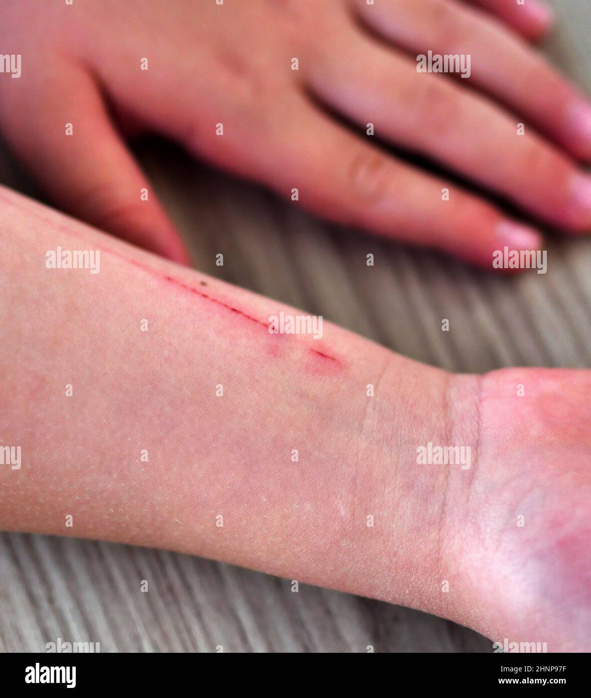 a child's scratched and injured arm,arm injuries Stock Photo - Alamy