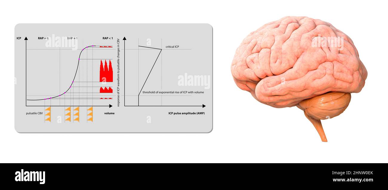 Intracranial Pressure Monitoring ICP waveform, 3d render, 2d graphic ...