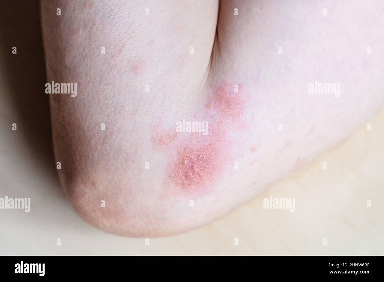Skin rash on elbow hi-res stock photography and images - Alamy