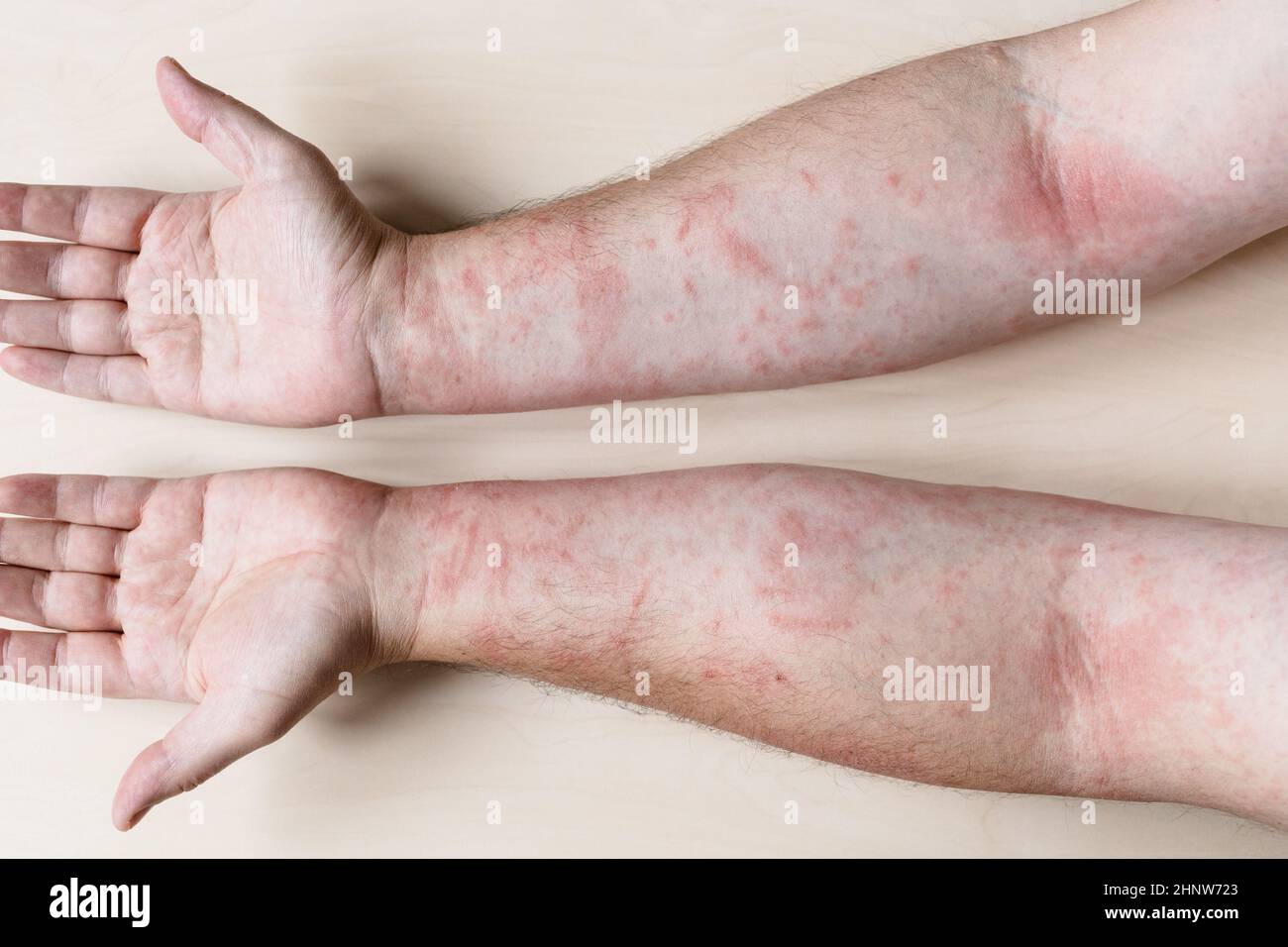 sample of Allergic contact dermatitis - male arms with inflamed skin ...