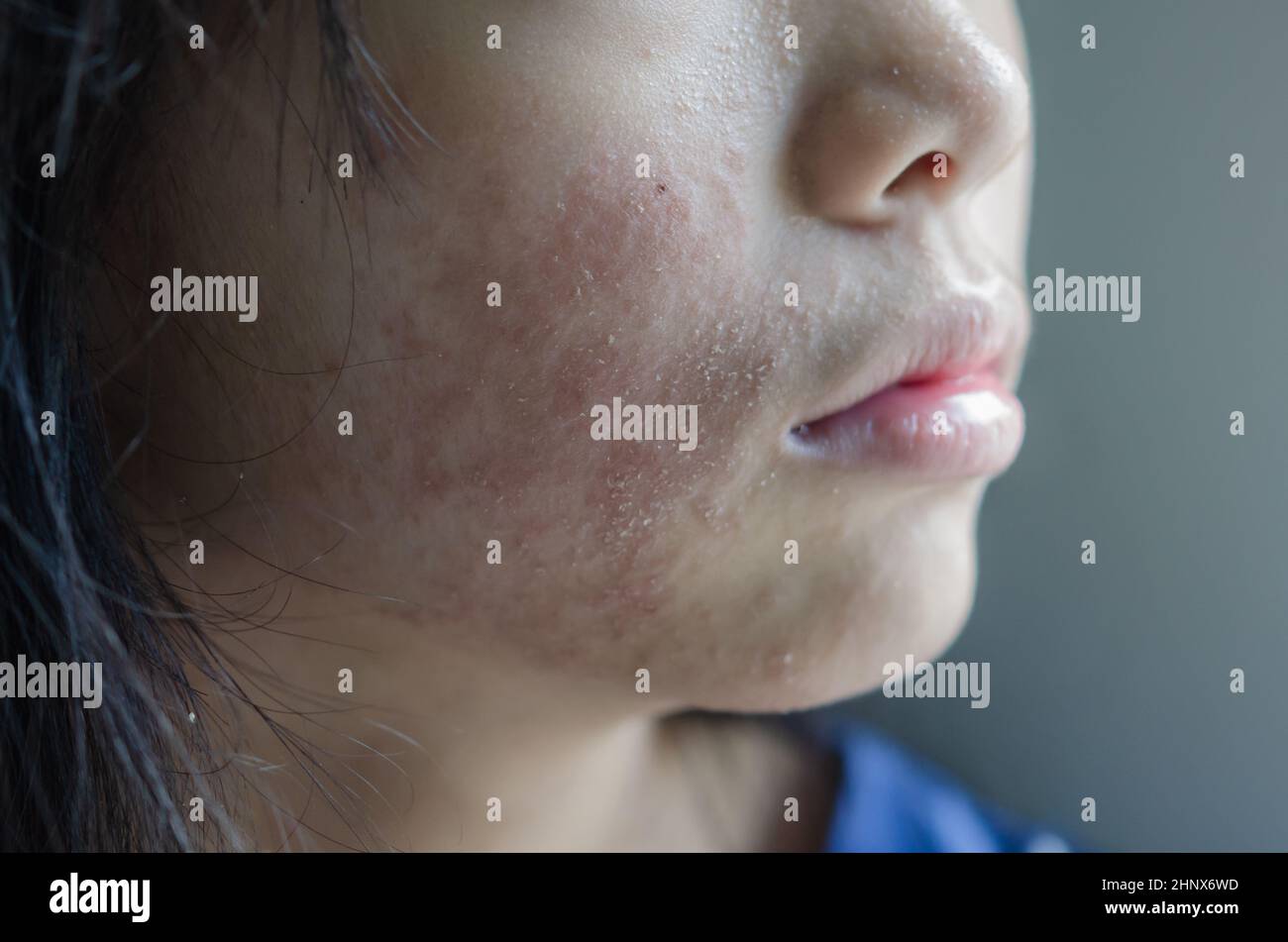 rash face woman allergic to cosmetics food allergy or air allergy Stock ...