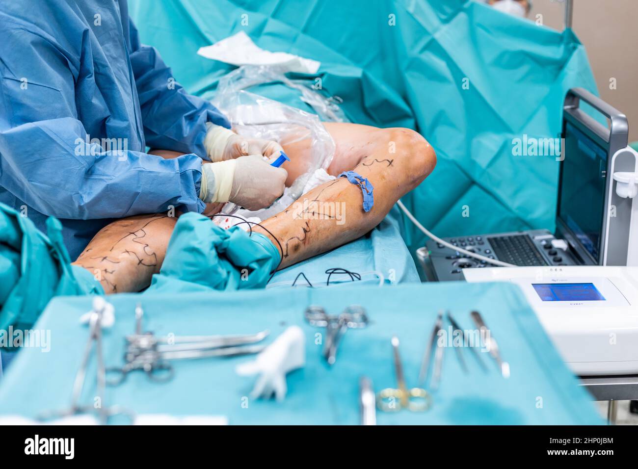 Surgery of varix or varicose a vein, vascular medicine, healthcare ...