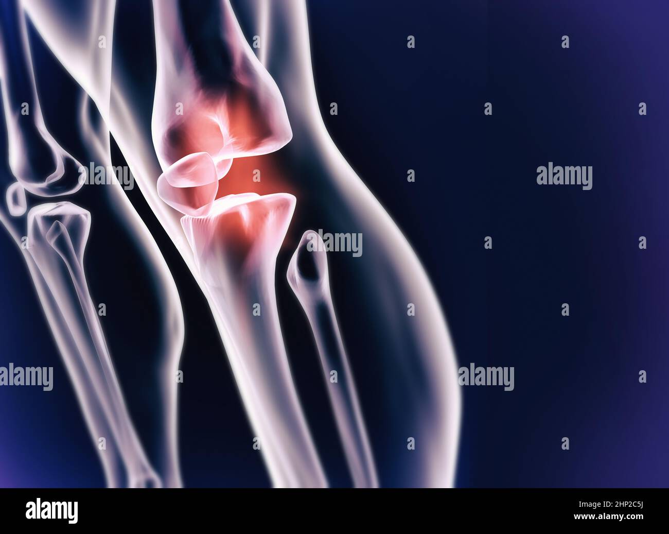 When inflammation strikes. A cgi view of an inflamed joint isolated on ...