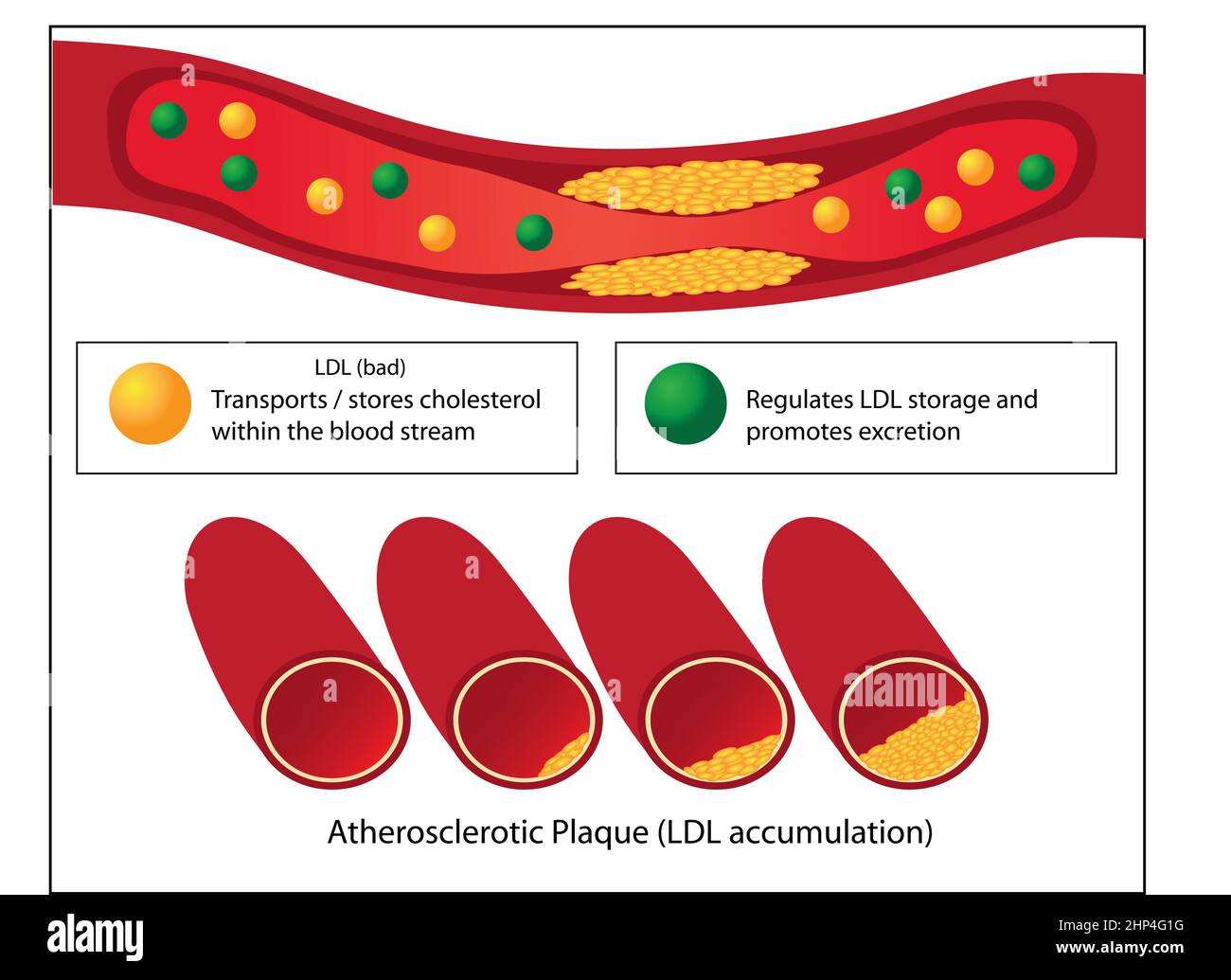 Role of good and bad lipids and levels of atherosclerotic plaque in ...