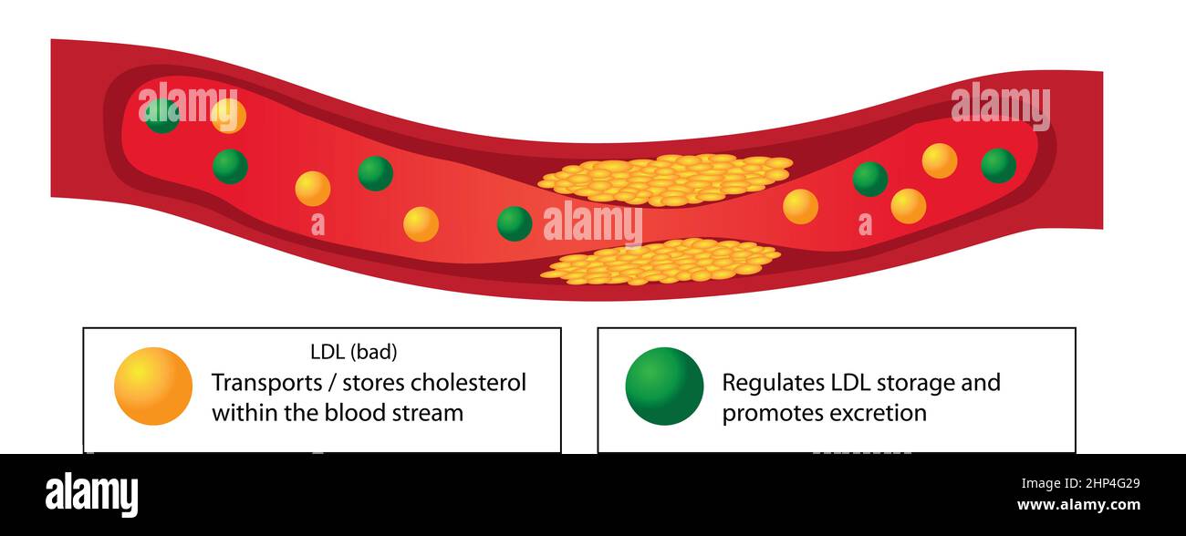 Atherosclerotic plaque in blood vessel and good and bad lipids vector ...