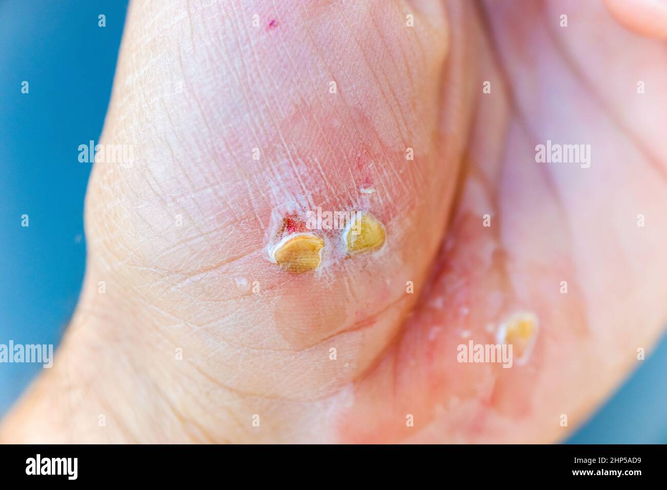 Hydrogen Peroxide Wound