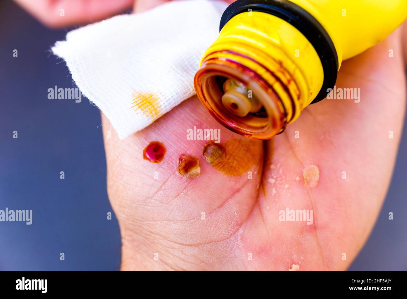 Application of iodine to clean wounds in the palm of one hand, and ...