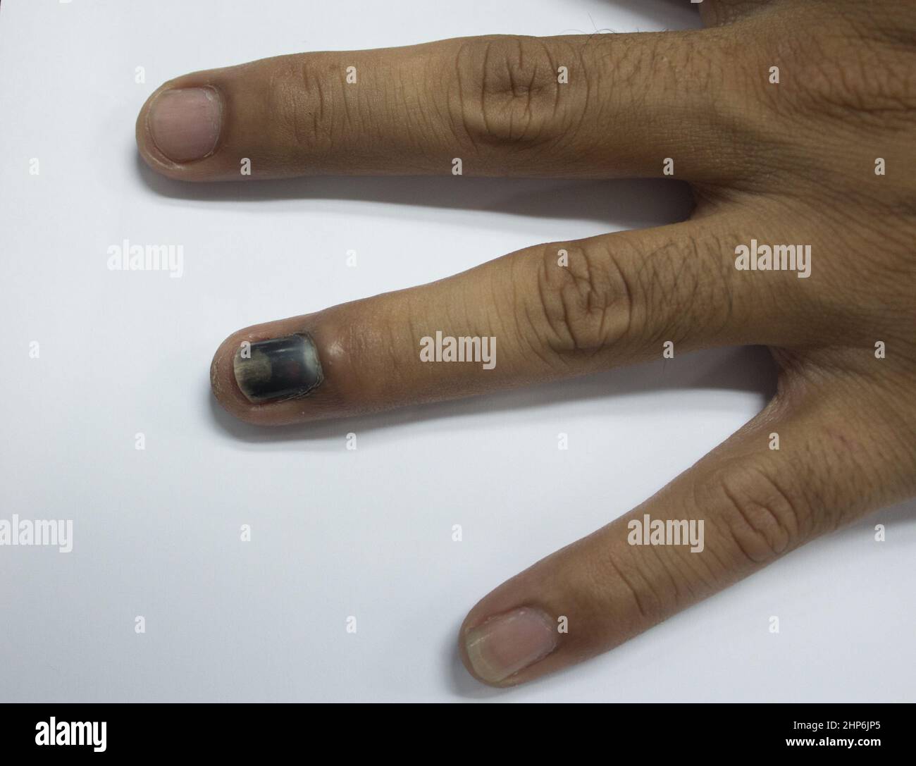 Finger muscle hi-res stock photography and images - Alamy