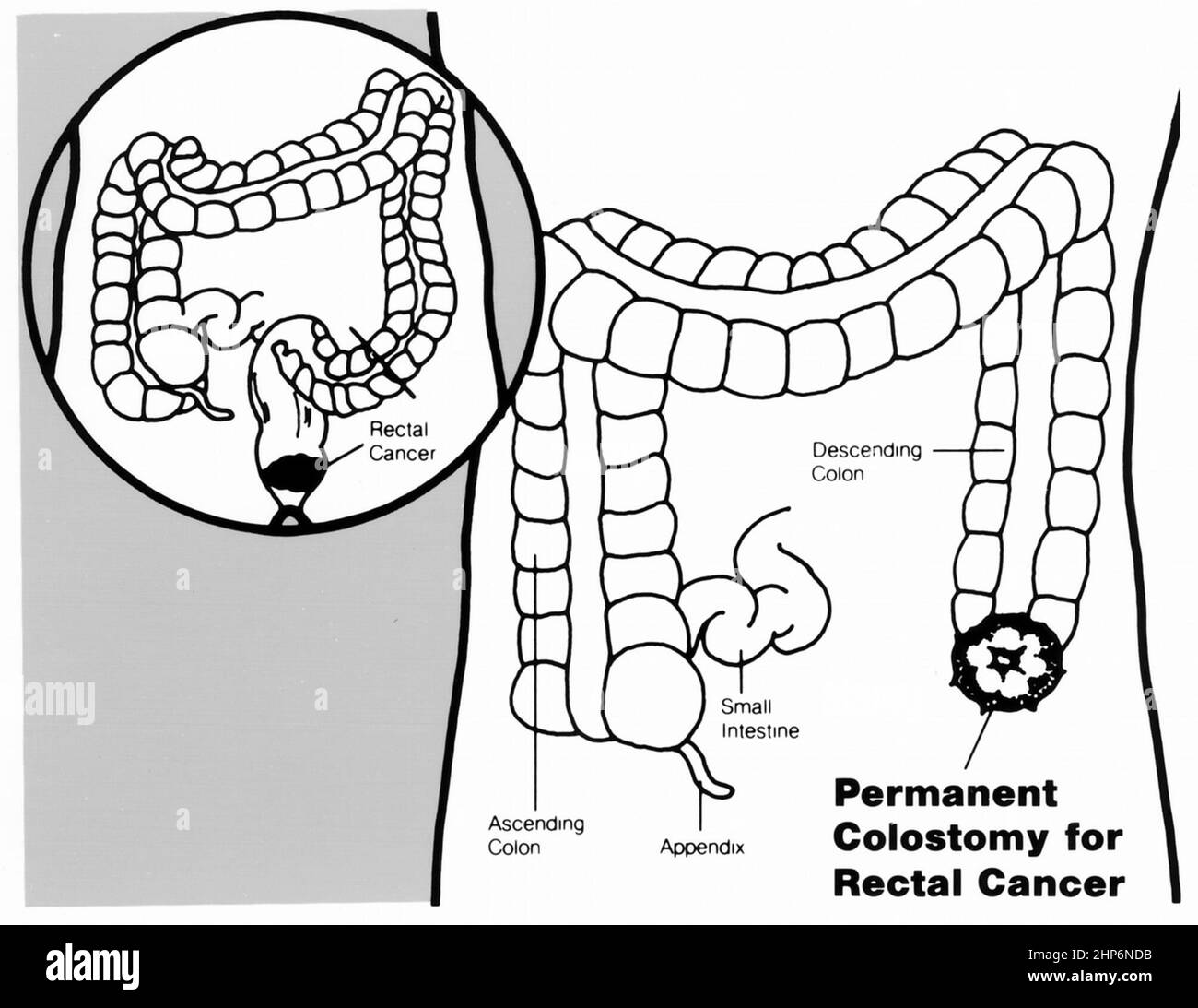 Rectal cancer Black and White Stock Photos & Images - Alamy