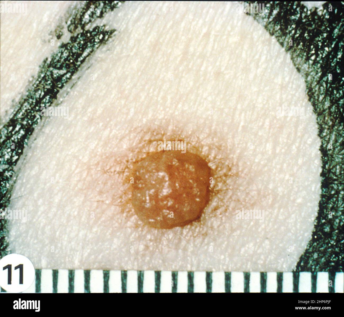 The delicate, hazy, tan macular rim of this lesion, although not ...