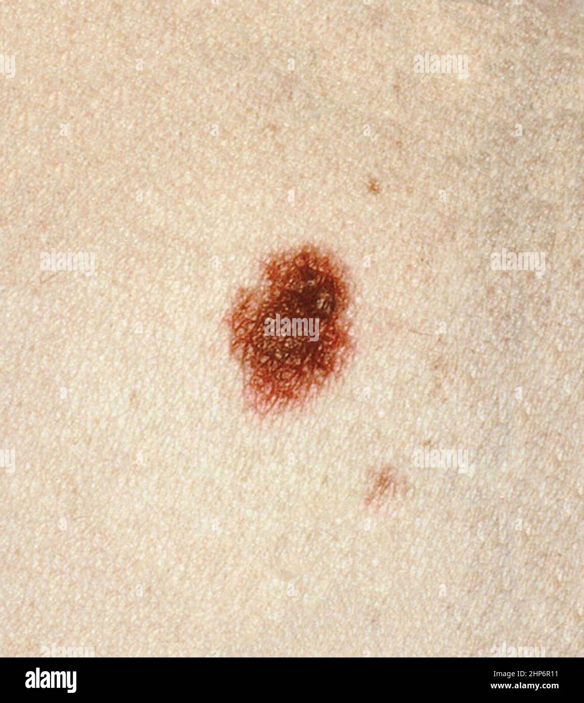 The central portion of this mole is a complex papule. The periphery of ...