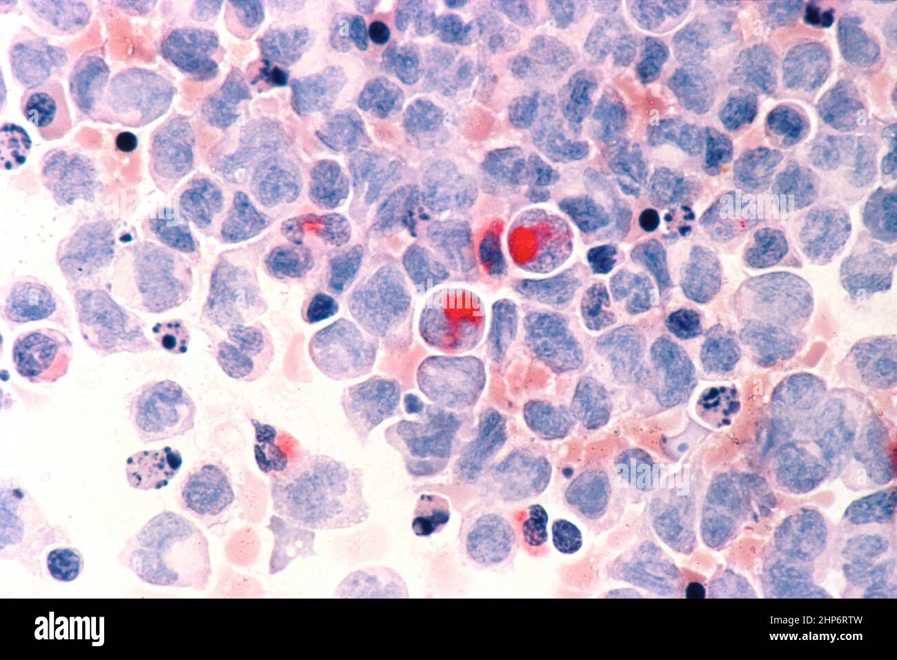 Human cells with acute myelocytic leukemia (AML) in the pericardial ...