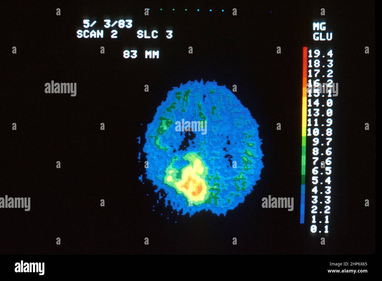 Positron emission tomography glucose hi-res stock photography and ...