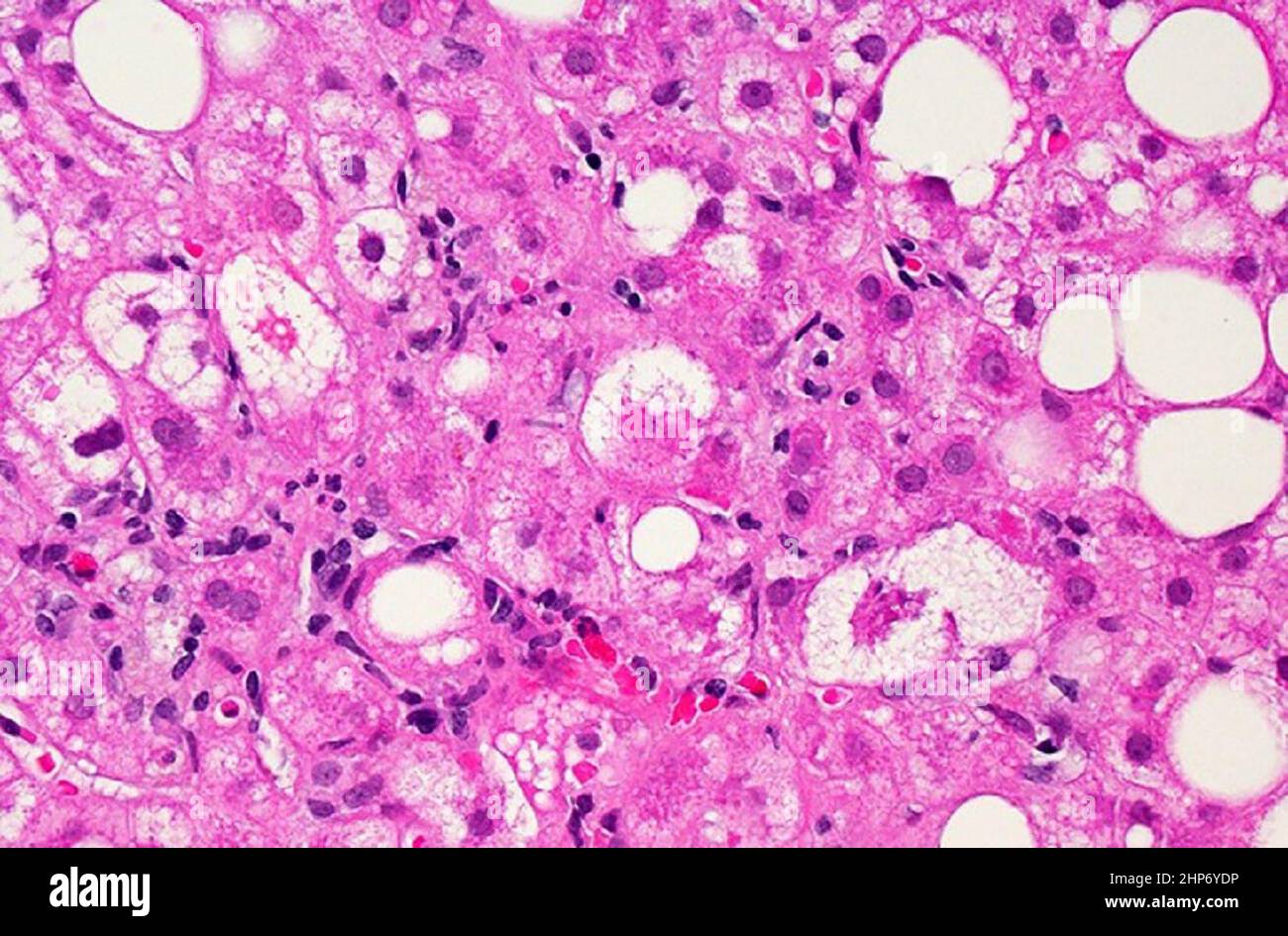 A microscopic image of liver tissue affected by non-alcoholic fatty ...