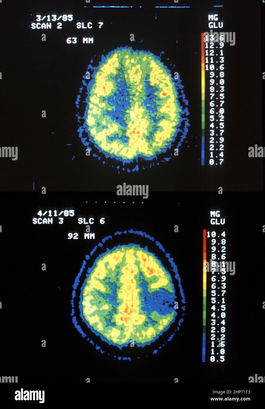 Two images - one showing a normal PET scan, the other showing ...