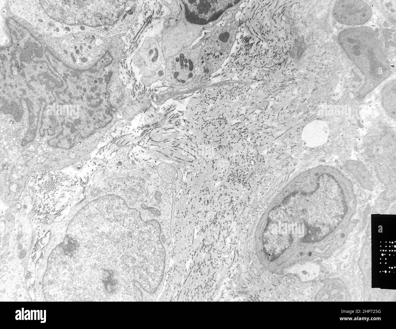 Soft tissue sarcoma photographed through an electron microscope ca ...