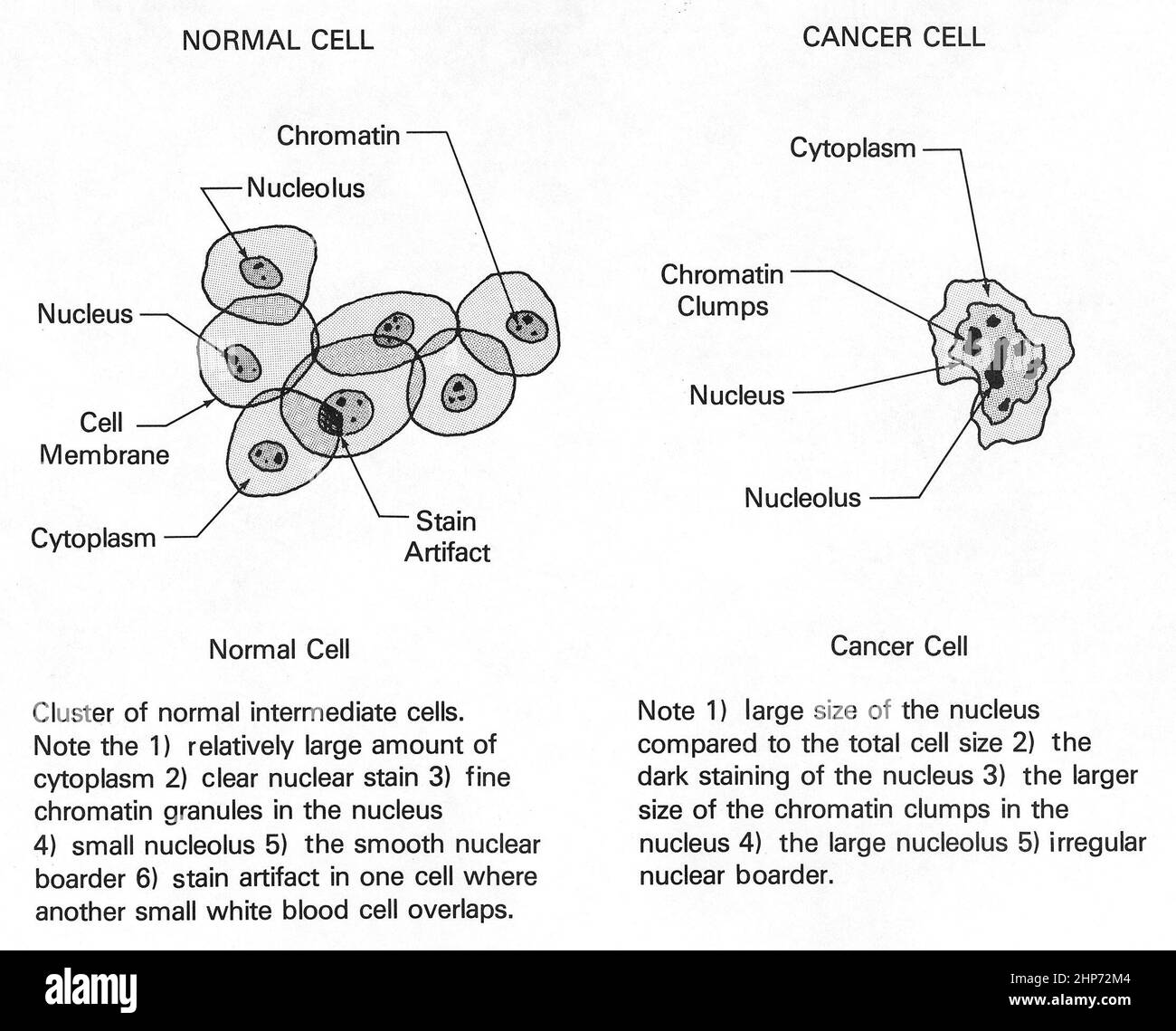 Graphics and description comparing normal and cancer cells ca. August ...
