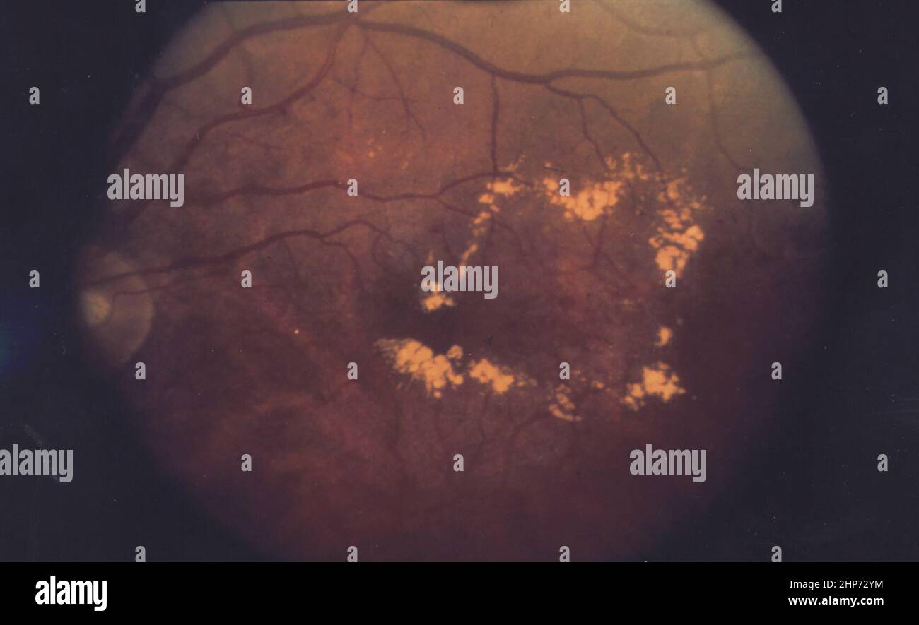 Edema macular hi-res stock photography and images - Alamy