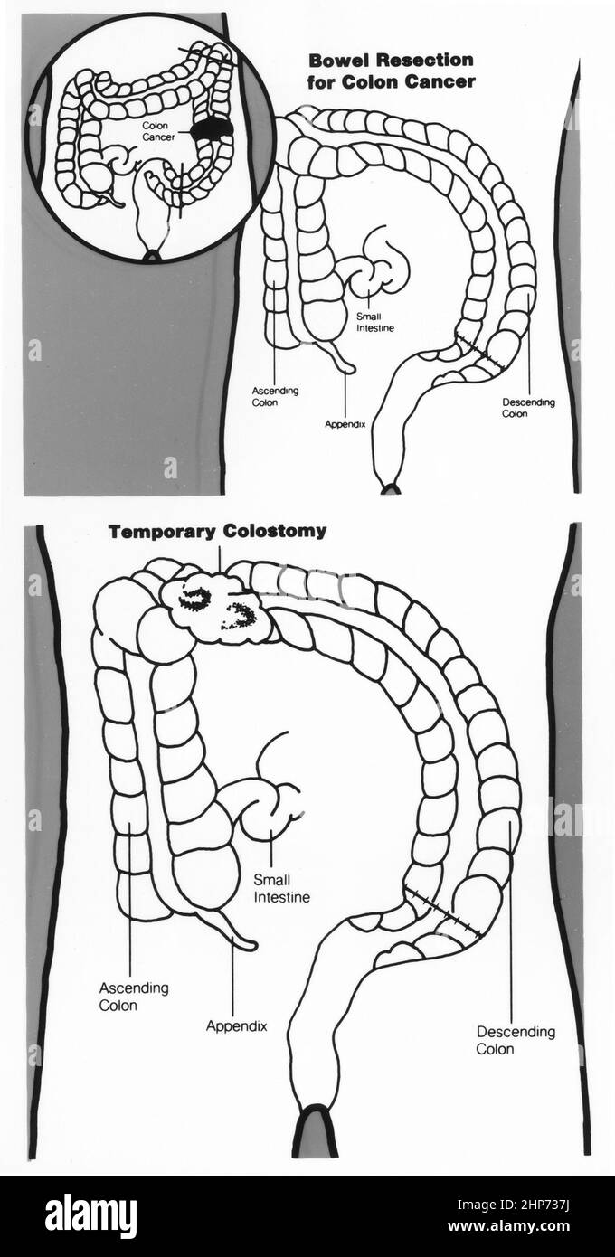 Line drawing showing bowel resection for a colon cancer and a temporary ...