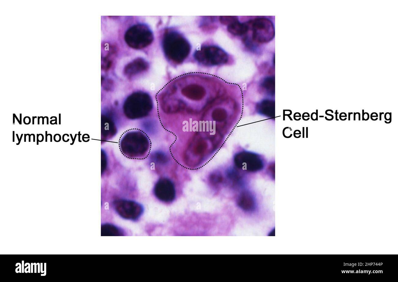 Reed-Sternberg cell; photograph shows normal lymphocytes compared with ...