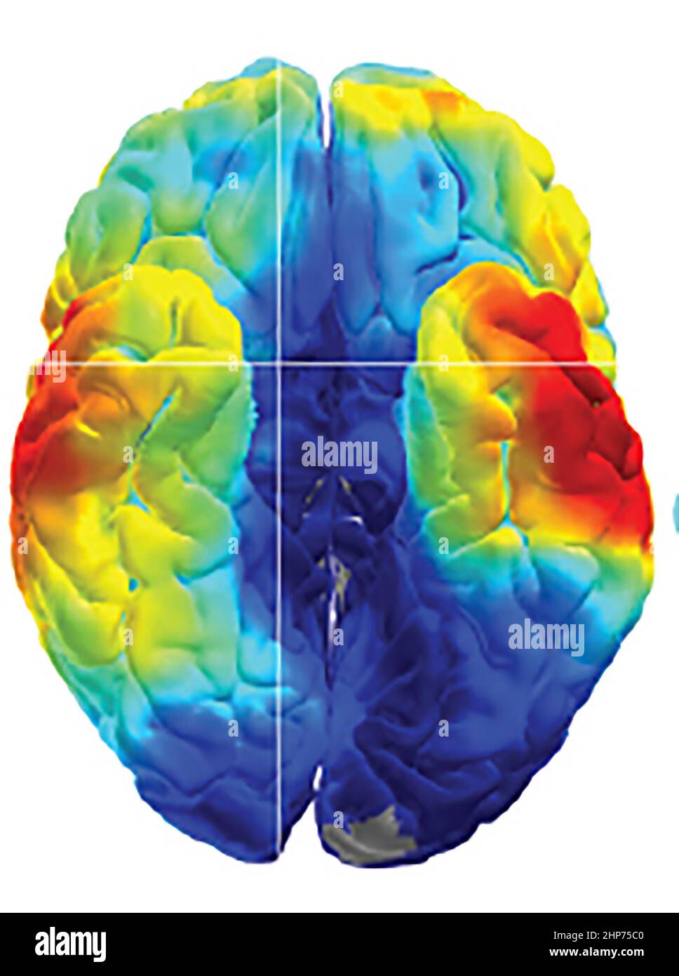 Scientists at NIH used electrical recordings to study how the human ...