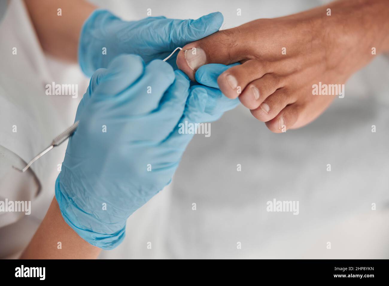 Podiatrist in blue gloves cleans toenail of man using special probe in ...