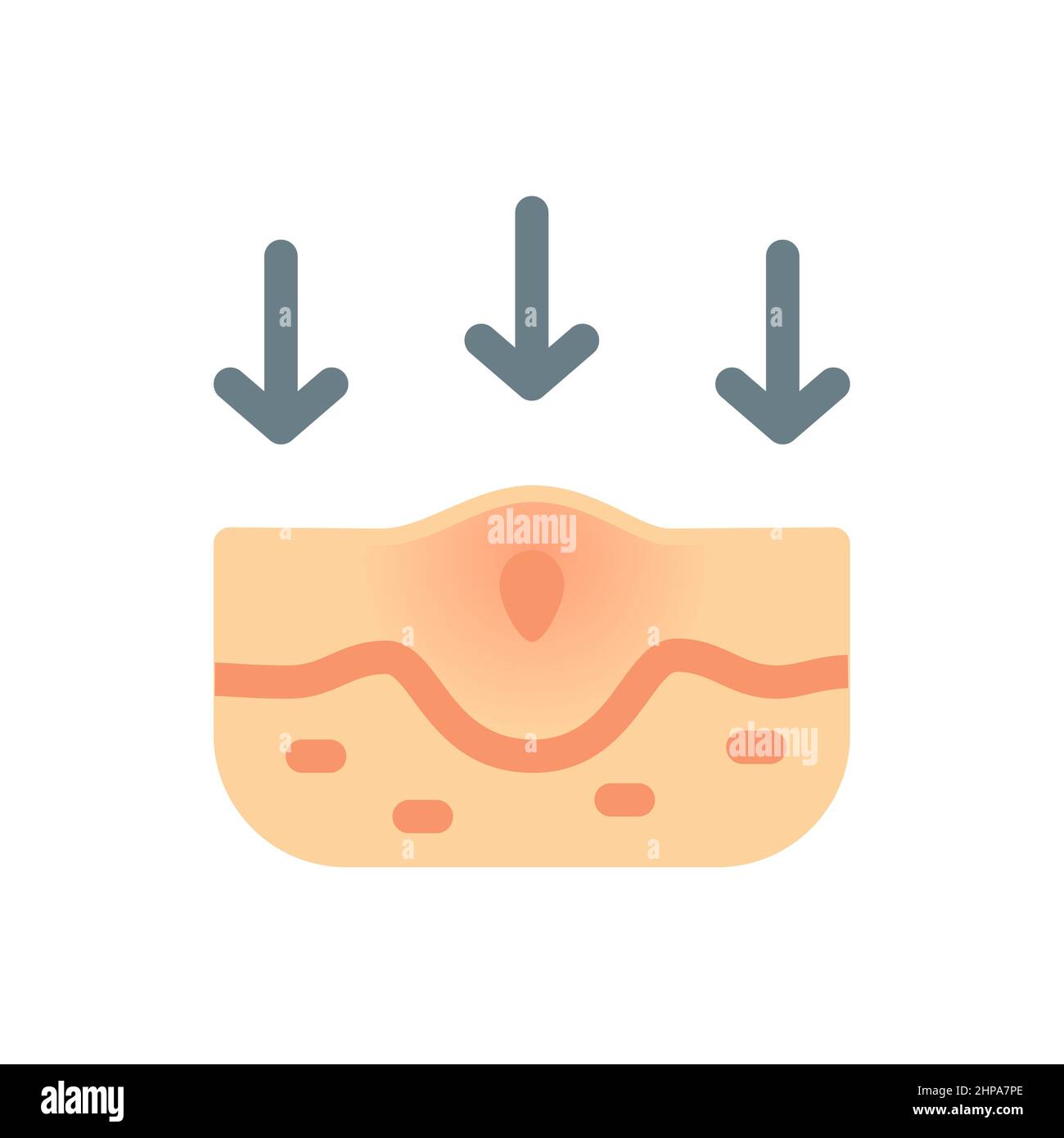acne care pimple epidermis dermatology single isolated icon with flat ...