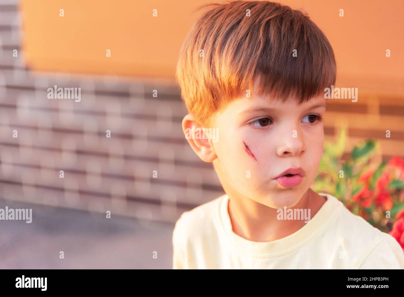 Portrait of a beautiful child with a bruise on his face Stock Photo - Alamy
