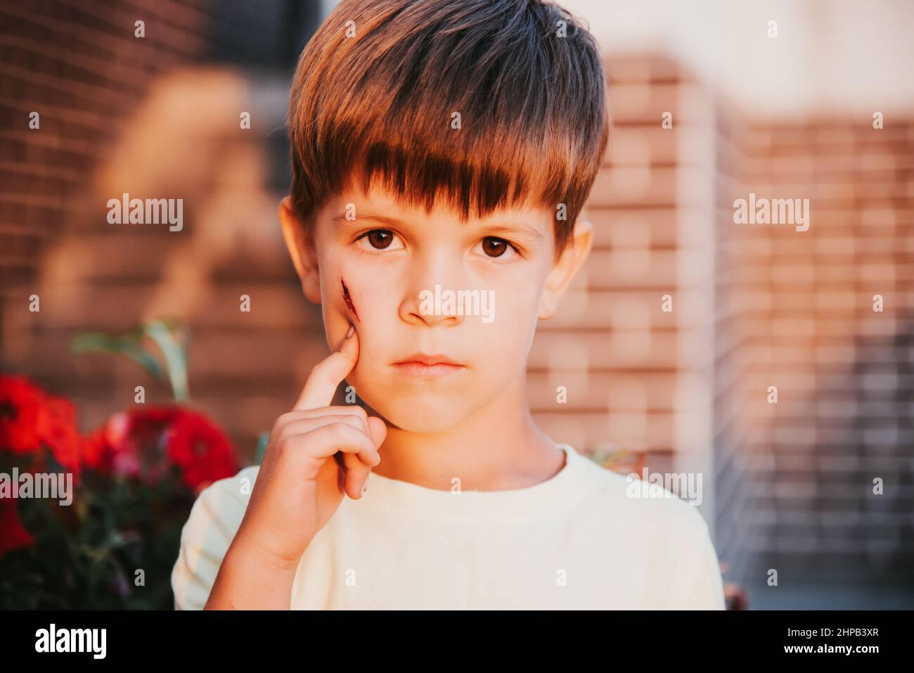 Portrait of a beautiful child with a bruise on his face Stock Photo - Alamy
