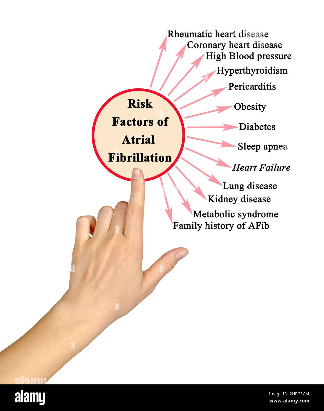 Risk factors of atrial fibrilation Stock Photo - Alamy