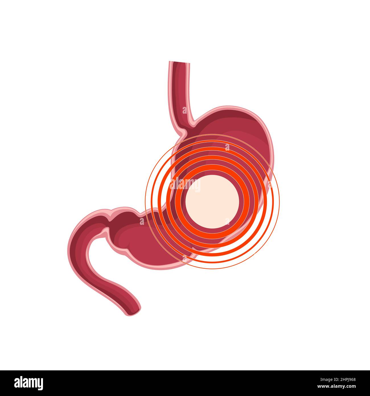 Human stomach with peptic ulcer Cut Out Stock Images & Pictures - Alamy