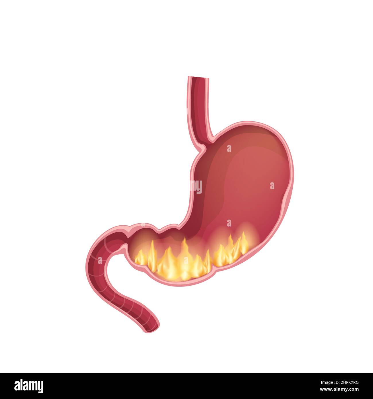 Realistic medical illustration of pyrosis stomach isolated. Fire ...
